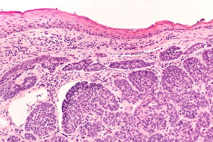 10 Trattamenti per il cancro della pelle - Salus.it