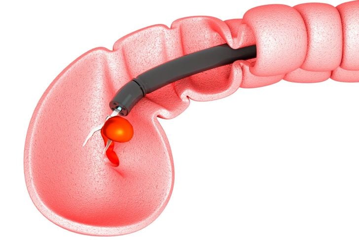 Domande frequenti su polipi del colon e polipi colorettali - Salus.it