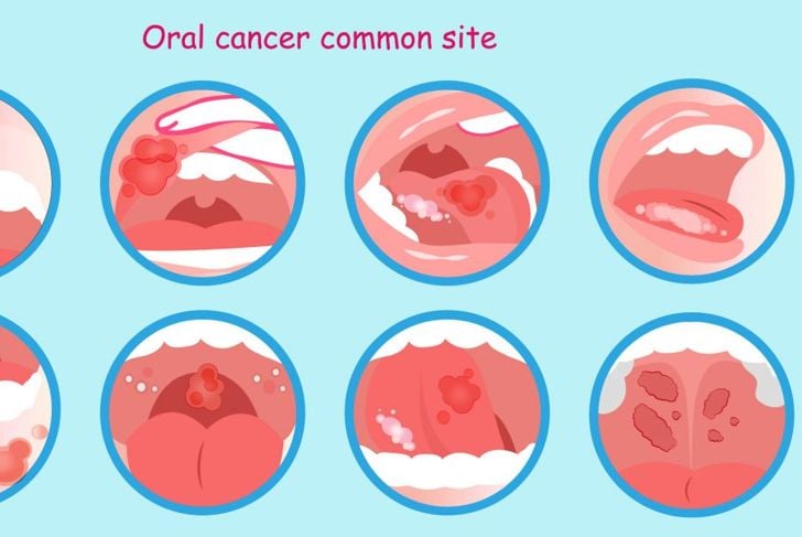 Che cos'è la leucoplachia? - Salus.it