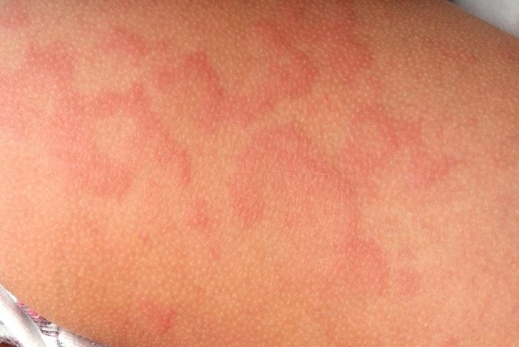 10 segni di scabbia - Salus.it