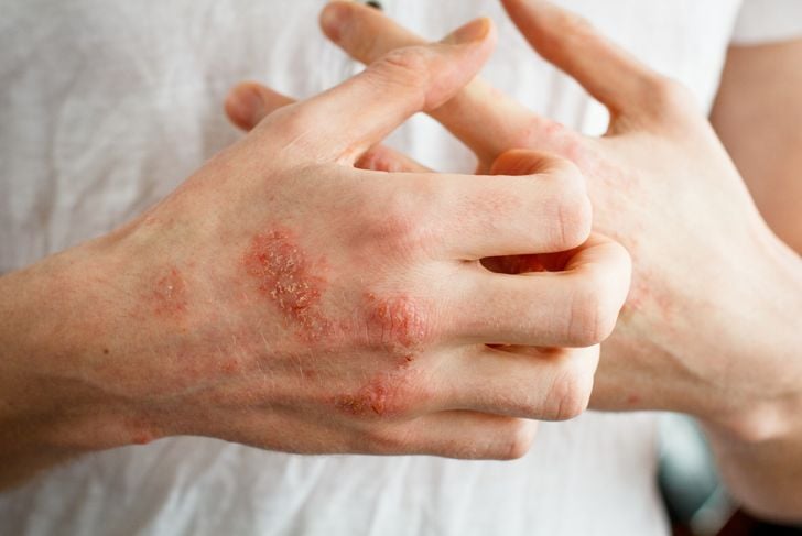 Che cos'è un granuloma annulare? - Salus.it